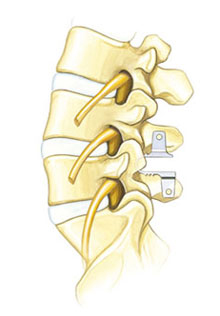 The Right Trial – Coflex® | Orthopedics This Week