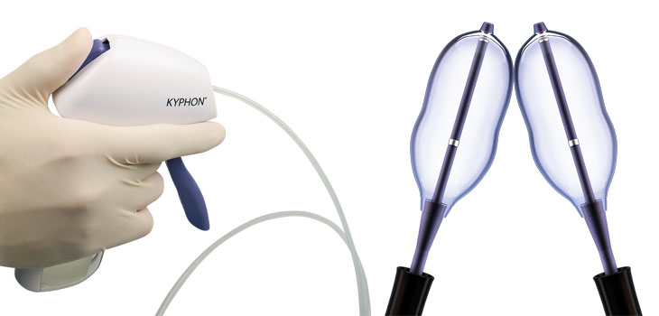 Medtronic’s Next Generation Kyphon System | Orthopedics This Week