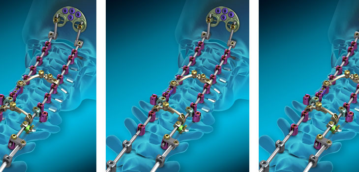 Infinity Occipitocervical-Upper Thoracic System Launched | Orthopedics ...