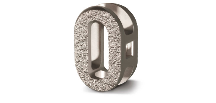 Titan Spine: Endoskeleton Looking Good Compared to PEEK | Orthopedics ...