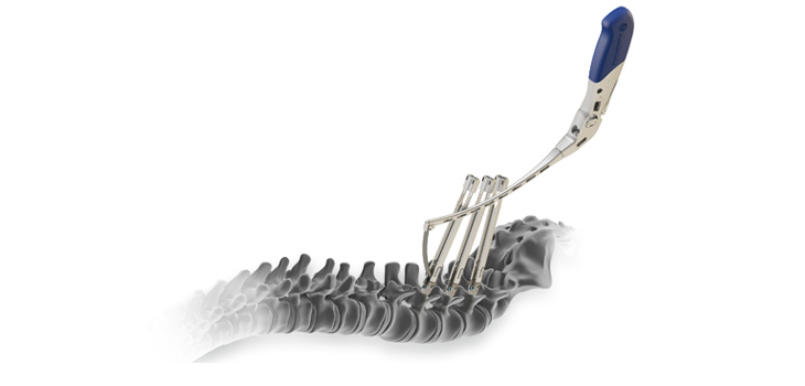 Medtronic Expands TLIF Procedure and Buys RF Surgical | Orthopedics ...