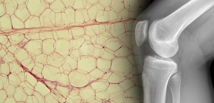 Watching Fat Cells Become Bone Cells: New Osteoporosis Info ...