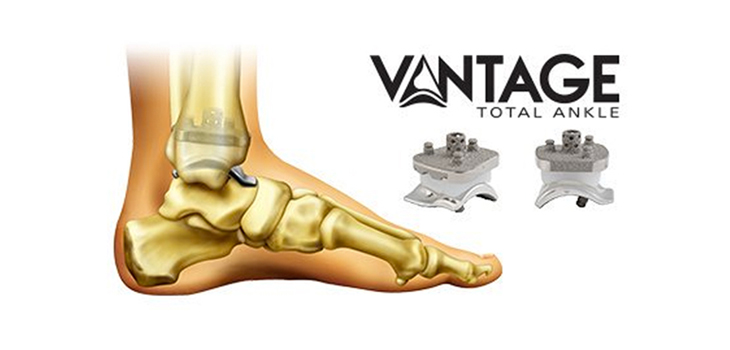 Exactech: First Surgery With Vantage Total Ankle System | Orthopedics ...