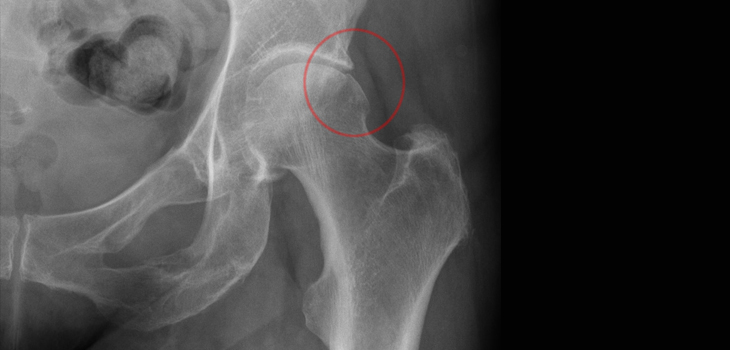 Hip Arthroscopy Chicago | Hip Impingement Chicago | Sports Medicine Weekly