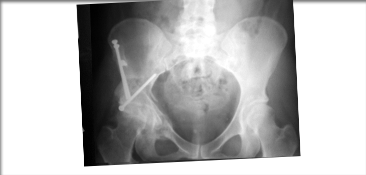 Acetabular Undercoverage, Overcoverage Associated With Hip OA ...
