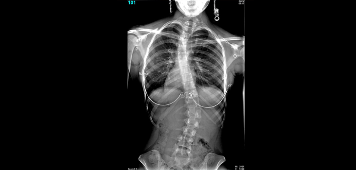Adult Spinal Deformity Guidelines | Orthopedics This Week