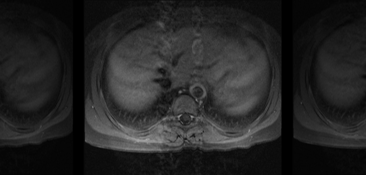 Gadolinium Mri