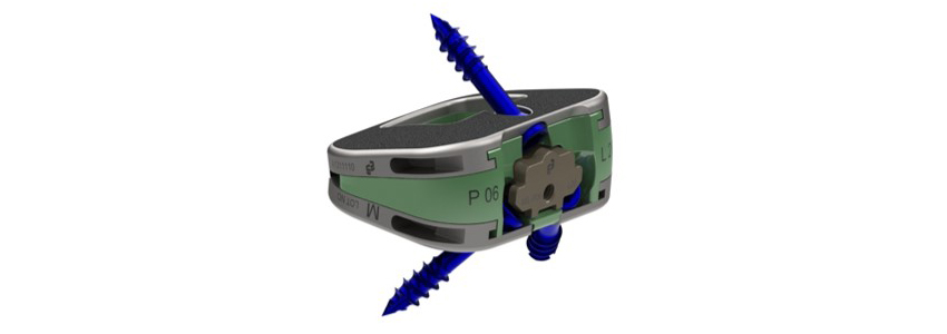 Axis Spine’s Modular Interbody Device Cleared | Orthopedics This Week