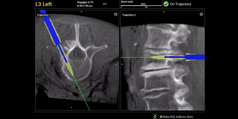 Medtronic’s Evolving 3-D Mazor Platform Gets New FDA Clearance ...