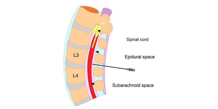 Dural Repair: Hydrogels or Epidural Blood Patch? | Orthopedics This Week