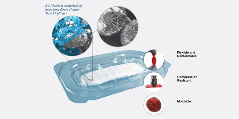 Novel BioGlass Fiber Bone Graft: 96.3% Spine Fusion | Orthopedics This Week