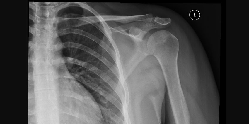 Joint Laxity and Hill-Sachs Lesions Width: How Relevant? | Orthopedics ...