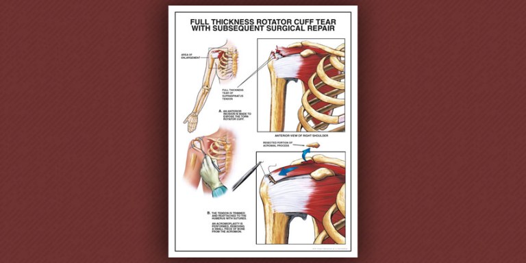 Open or Arthroscopic Rotator Cuff Repair? | Orthopedics This Week