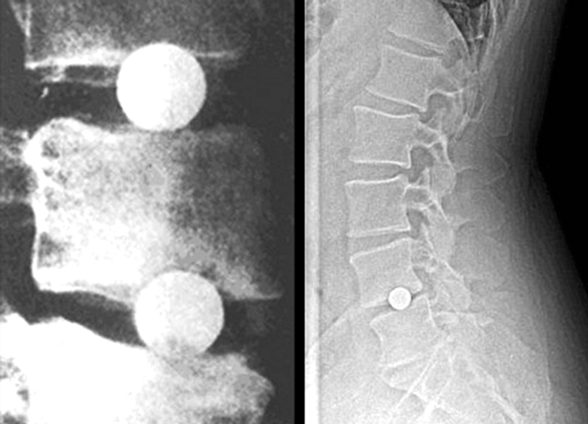 History of the Fernstrom Ball, BAK and Spine-Tech — Part I ...