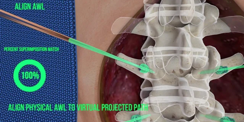 FDA Clears Novel Augmented Reality Spine System | Orthopedics This Week