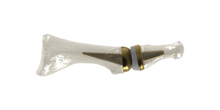 World’s First 3D Printed Toe Joint Replacement! | Orthopedics This Week