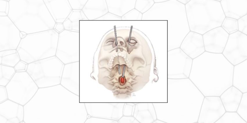 Removing a Spinal Tumor Through Eye Socket - Orthopedics This Week