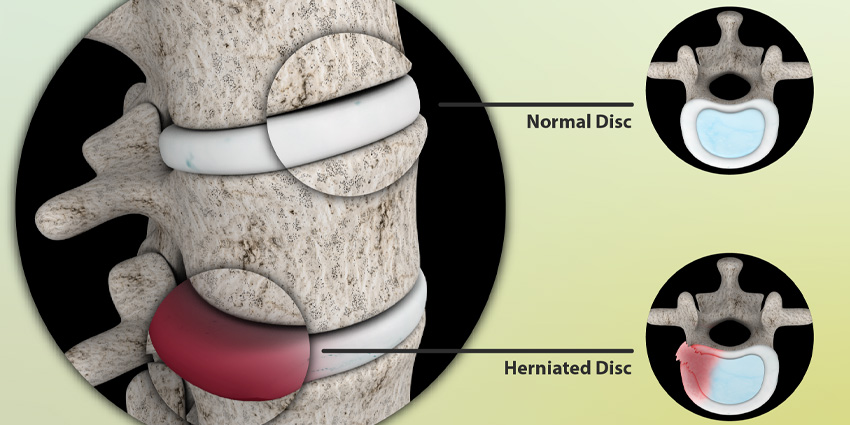 Spontaneous Disc Resorption: The Lumbar Spine Comeback Kid ...