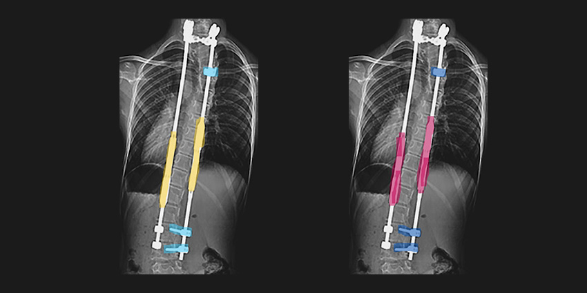 Growing Rods: Is the Second Surgery Worth It? - Orthopedics This Week