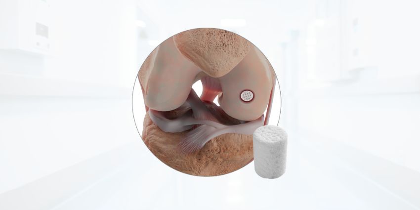 A Win for Cartilage Repair: CPT Code for CARTIHEAL™ AGILI-C ...