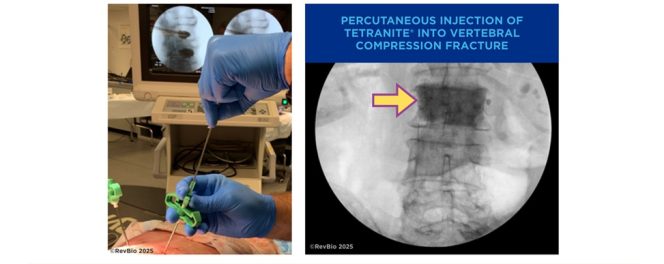 RevBio Receives a $2.2 Million Phase II NIH Grant to Further Develop ...