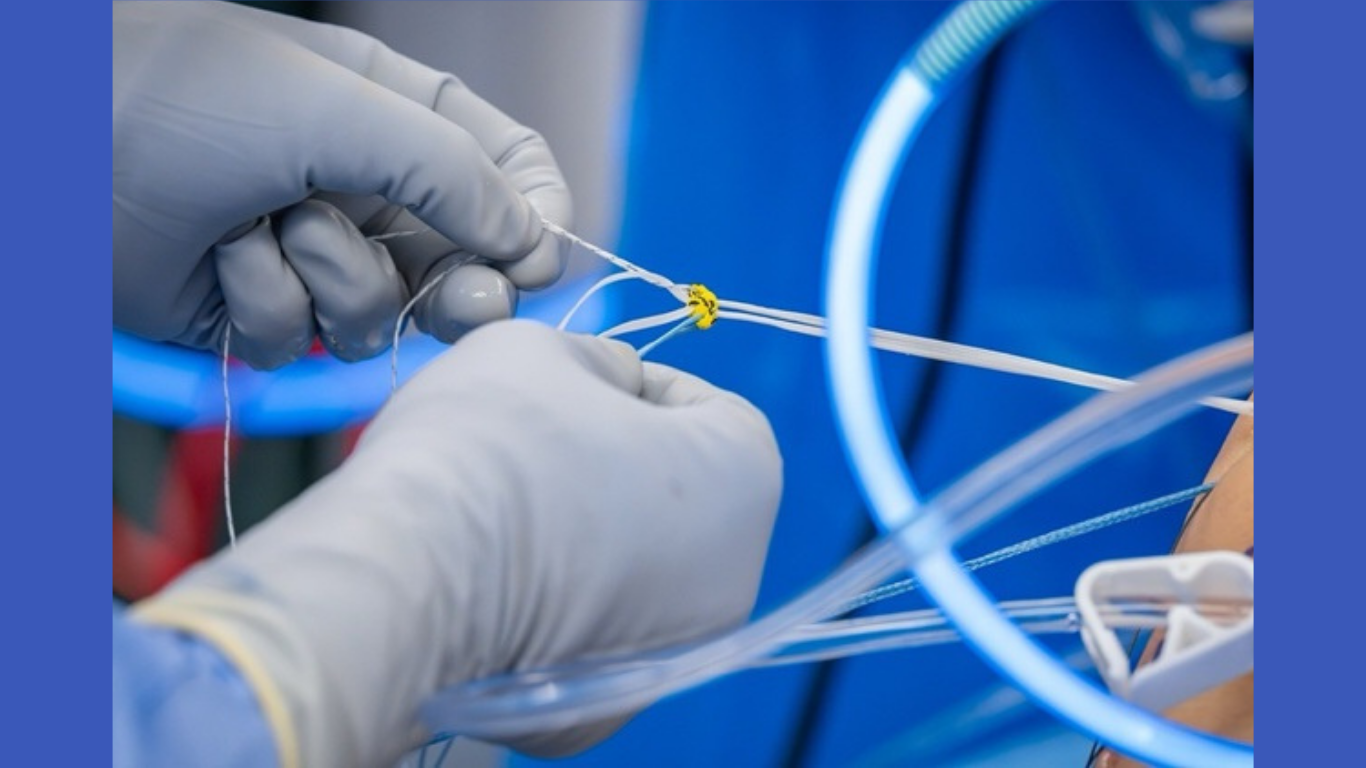 Arthrex Releases TightRope® SB All-Suture Implant for ACL Fixation ...
